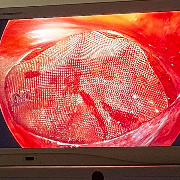 Plastia Inguinal Laparoscopica - CEMIH